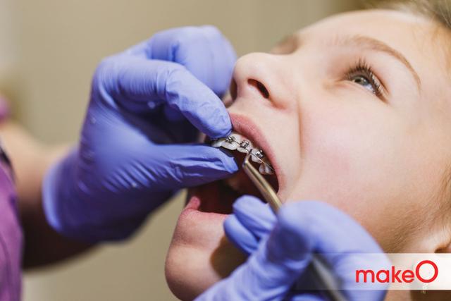 A Complete Guide to Braces Wax