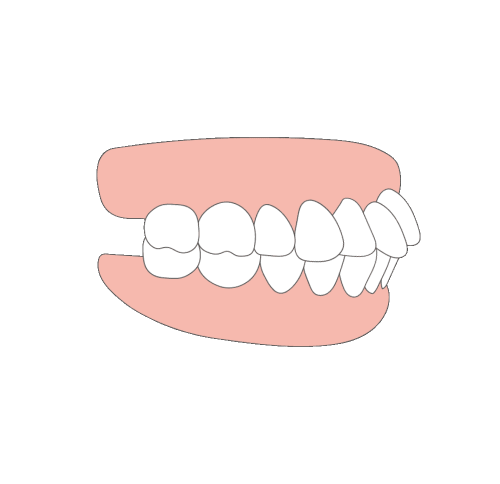 Invisible Aligners & Braces for Kids or Teenagers | Tootshi