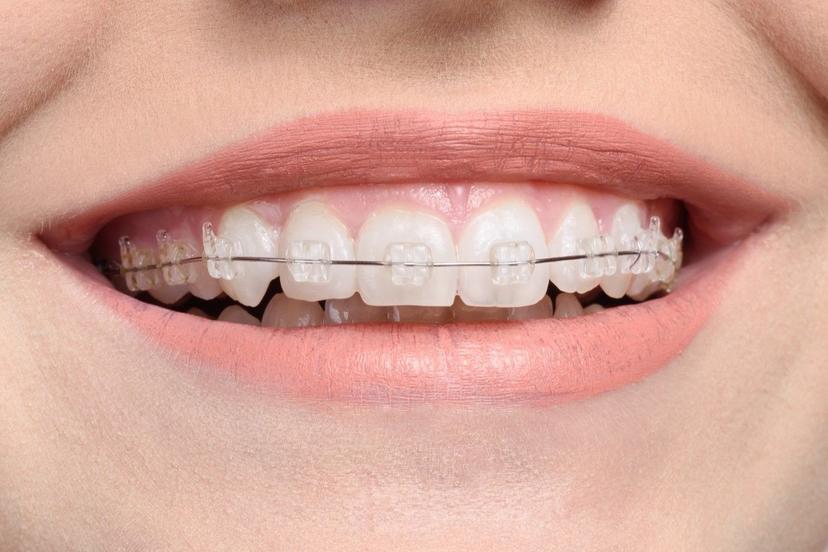 Teeth Braces cost in India | toothsi by makeO