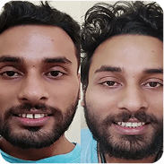 toothsi Reviews, Customer Teeth Treatment Results & Feedback | makeO ...