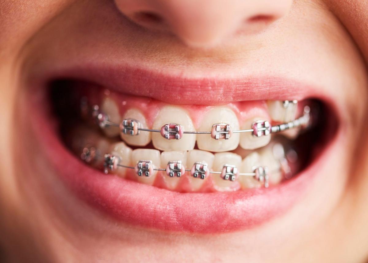 Teeth Braces cost in India | toothsi by makeO