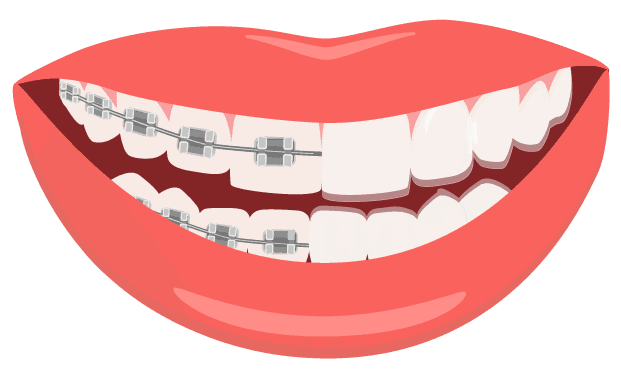 toothsi Aligners: Get Customized Teeth Aligners at Just Rs. 3019/month ...